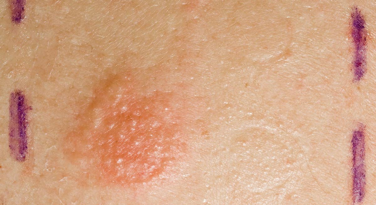 Patch Testing for IBS | Chestnut Hill Allergy & Asthma Associates, LLC